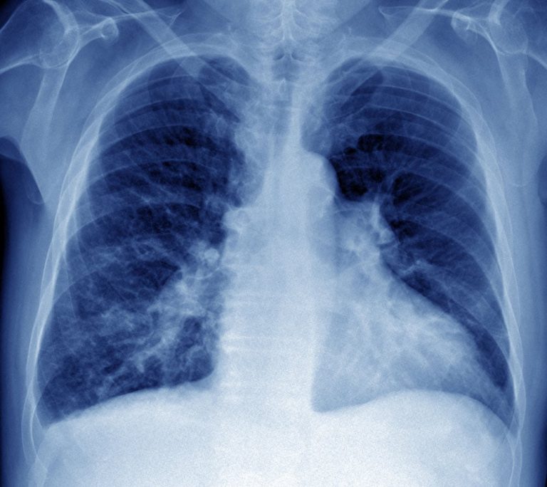 Safety and Feasibility of Treprostinil Pump Implantation in Patients ...